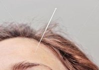 Acupunctura - BioCampello